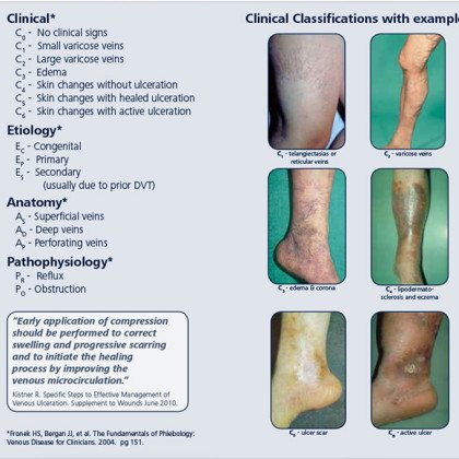 Superficial Thrombophlebitis Treatment in Houston, TX